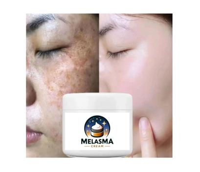 Melasma Cream Creme para tratar melasmas e manchas 30g. - Hidratante ...
