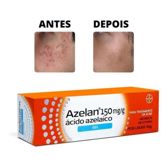Azelan Ácido Azelaico Creme Tratamento Espinha Acne 30g - Acnezil ...