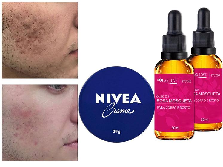 Kit Creme Nivea Anti-rugas Clarear Melasma Sardas Masculino - Max Love ...