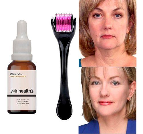 Kit Microagulhamento + Sérum Rugas Flacidez Ácido Glicólico ...