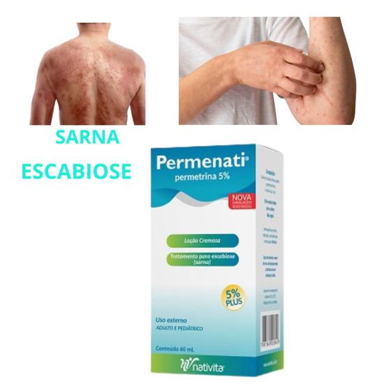 Permenati 5% Permetrina Loção para Sarna Escabiose Coceira no Corpo ...