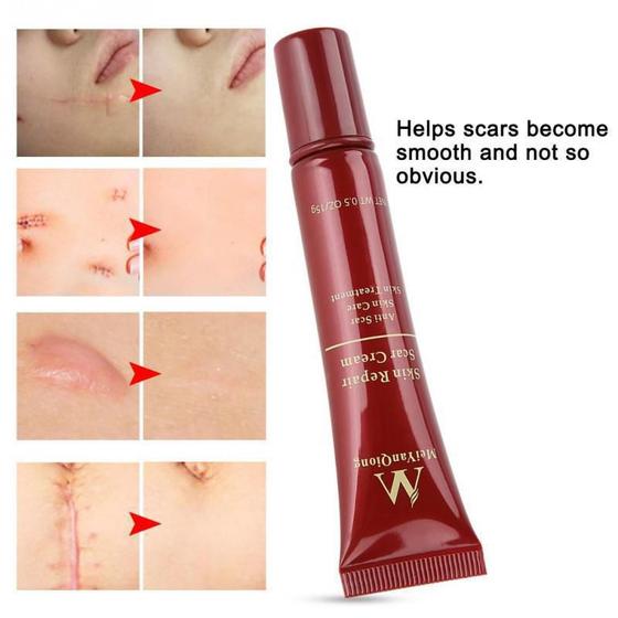 Skin Repair Scar Cream - Creme Redutor De Cicatriz - 15 G - Meiyanqiong ...