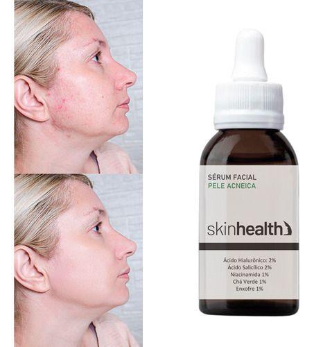 Tratamento De Cravos E Espinhas Skincare 60ml Sh - Skinhealth ...
