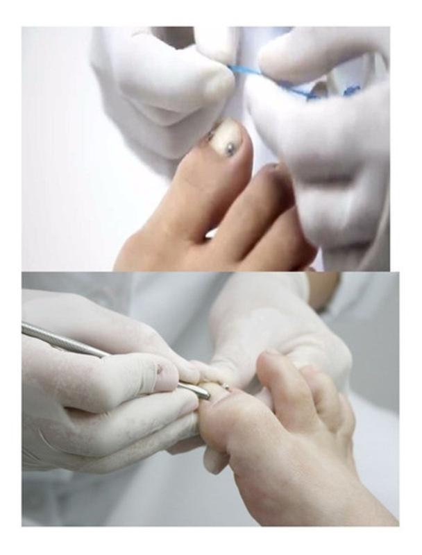 Kit Botão e elástico kit corretor de unha encravada órtese spa das ...